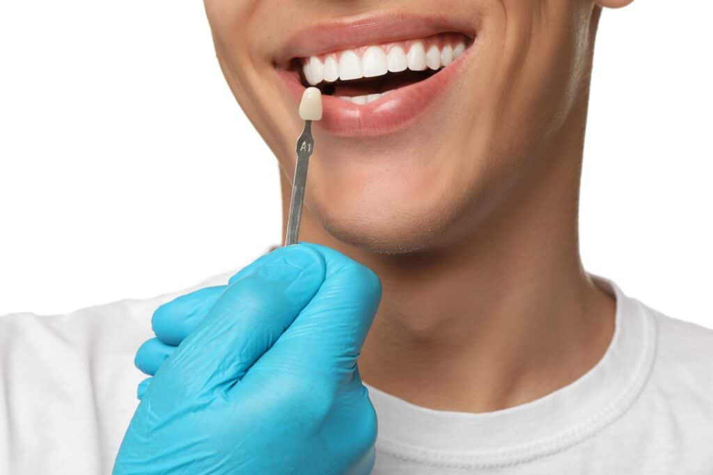 Dental Veneers in Columbia – Stain-Resistant Smile Makeovers
